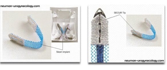 Justice Hits Hard in J&J Pelvic Mesh Case - $20M Verdict - Legal Reader