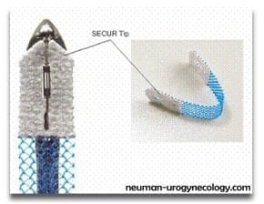 Johnson and Johnson Must Pay $57M in Pelvic Mesh Case - Legal Reader